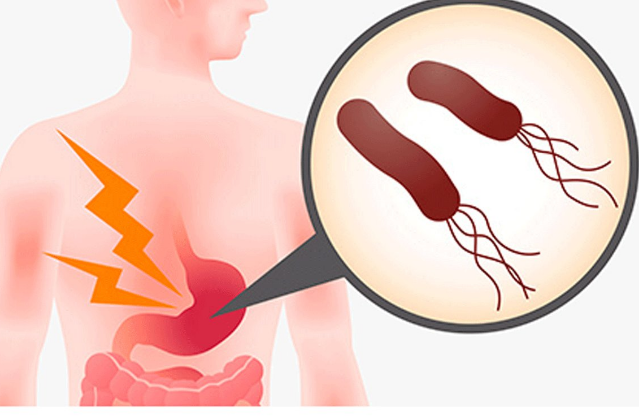 Deset najčešćih simptoma infekcije heliko bakterijom - Cuvajzdravlje.ba