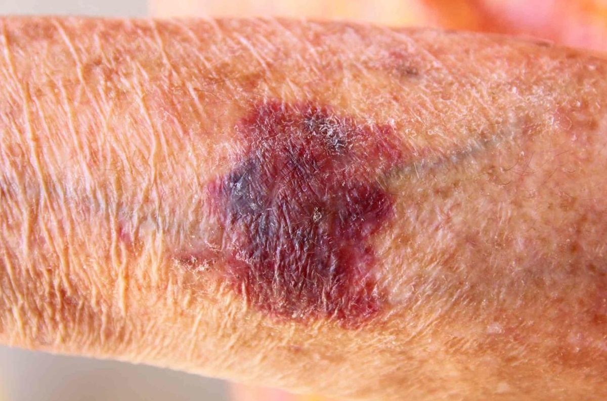 Purpura: Razumijevanje kožne bolesti i njene varijante - Cuvajzdravlje.ba