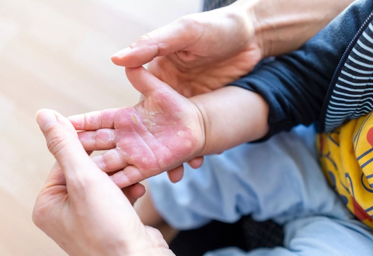 Opekotine kod djece: Prevencija i sigurno okruženje - Cuvajzdravlje.ba