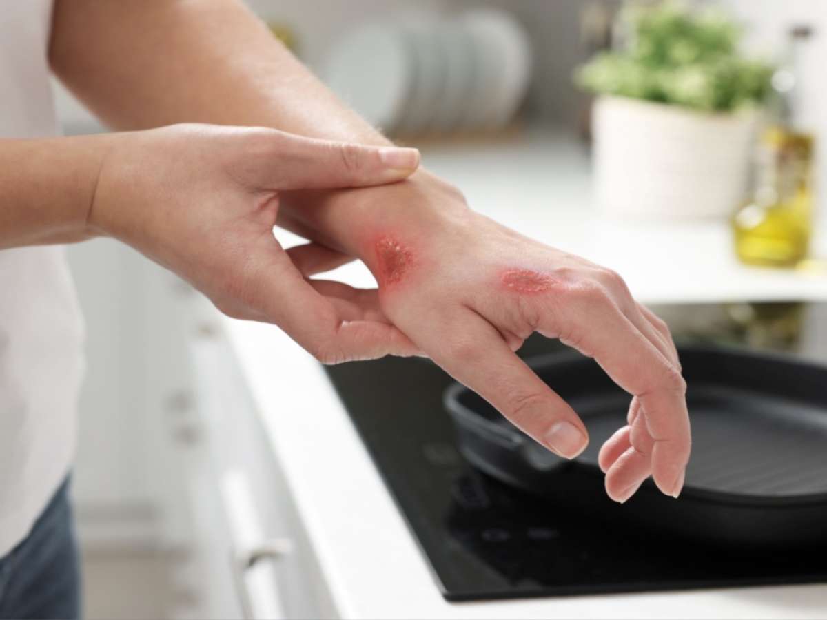 Pomozite svojoj koži: 'Kućni recepti' za ublažavanje opekotina ...